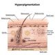 Informative Hyperpigmentation Drawings For Awareness