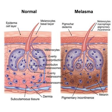 Informative Hyperpigmentation Drawings For Awareness